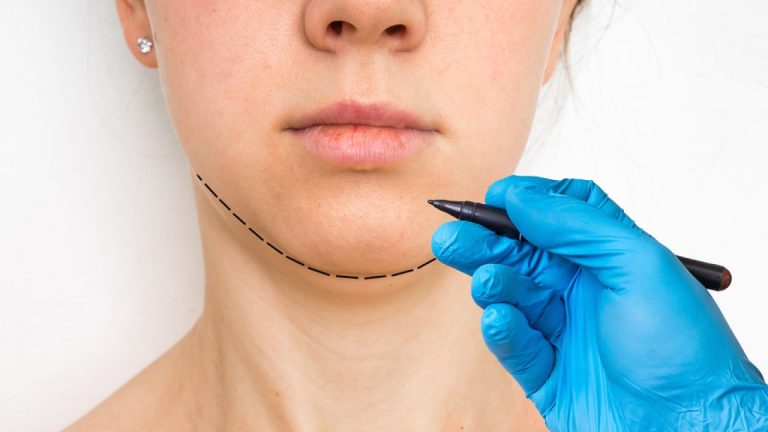 Çene Altı Yağlarınızdan Kurtularak Gençleşebilirsiniz - Estetik Rehberi